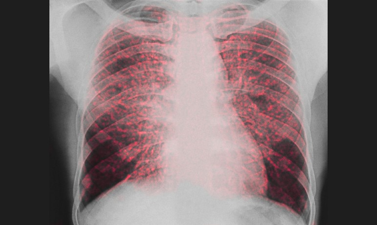 Million faces of sarcoïdose | MedNet