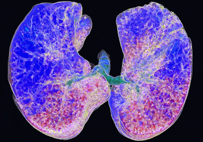 Vroege progressie voorspelt overleving van patiënten met sclerodermie ...