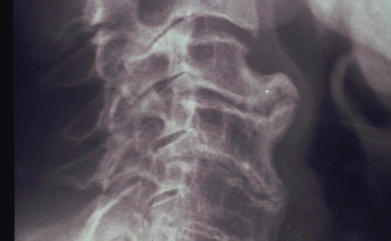 DISH veroorzaakt nogal eens ademhalingsproblemen | MedNet