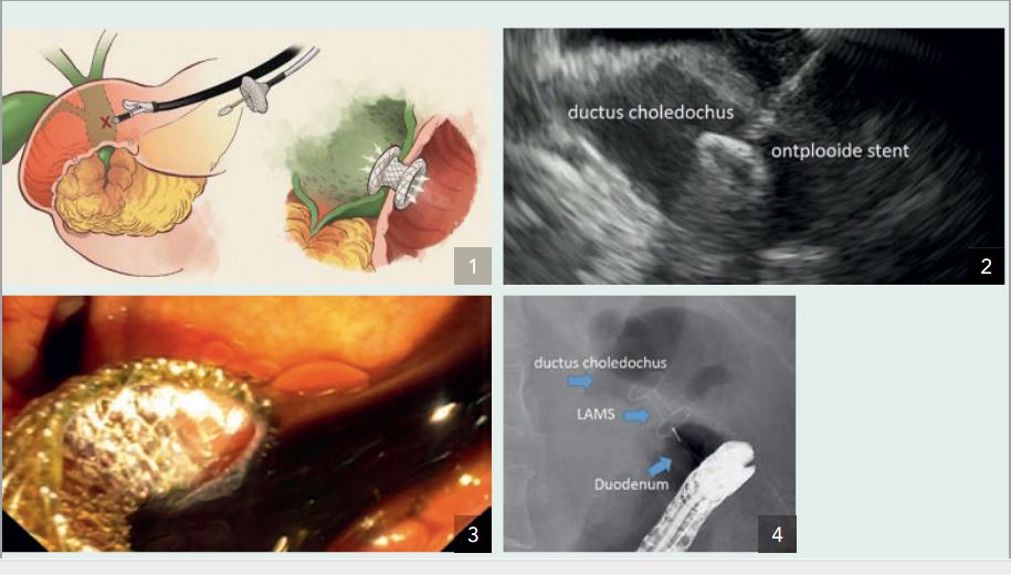 Endoscopisch creëren van een choledochoduodenostomie | MedNet