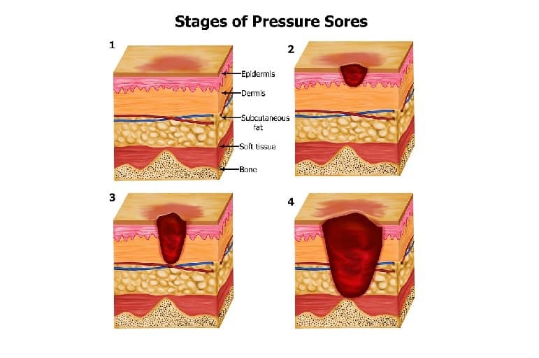 Recente richtlijn biedt praktische tips voor detectie en aanpak van ...