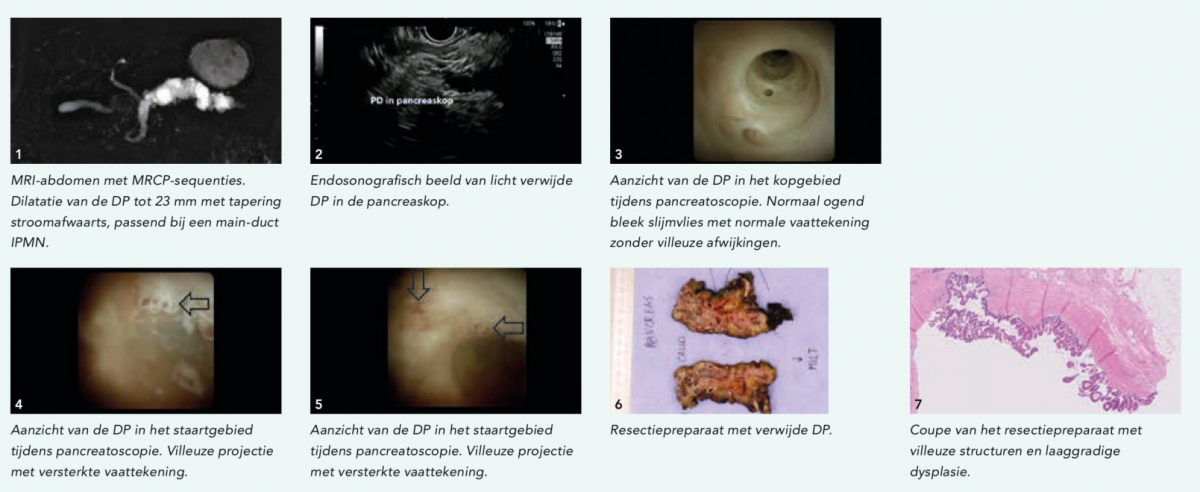 Intra-operatieve pancreatoscopie voor intraductaal papillair mucineus ...