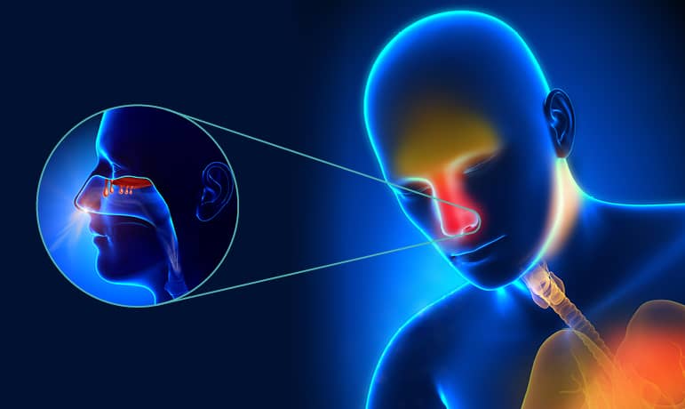 Multidisciplinaire aanpak van chronische rhinosinusitis met ...