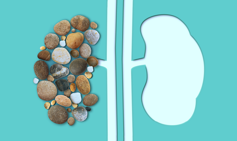 Recidiverende nierstenen: diagnostiek en behandeling vereist een ...