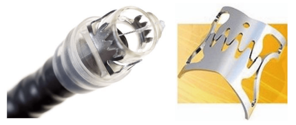 Over-the-scope-clips beter dan standaard endoscopische behandeling voor ...