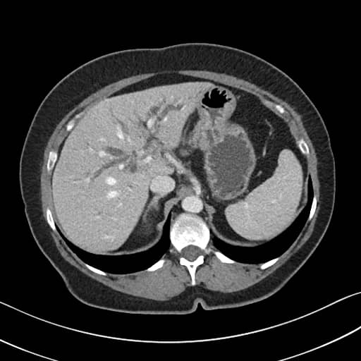 Endobiliaire radiofrequente ablatie ter preventie en behandeling van ...