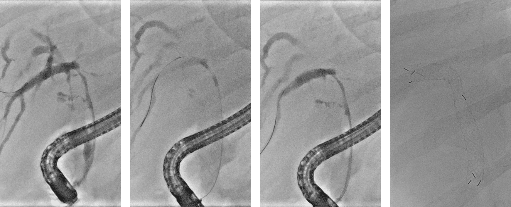 Endobiliaire radiofrequente ablatie ter preventie en behandeling van ...