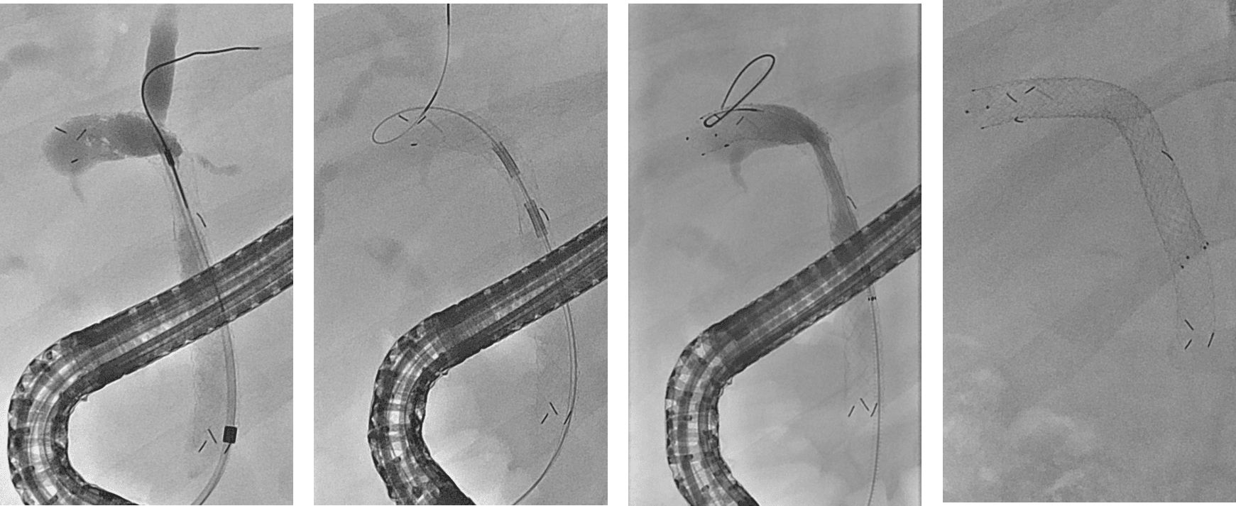 Endobiliaire radiofrequente ablatie ter preventie en behandeling van ...
