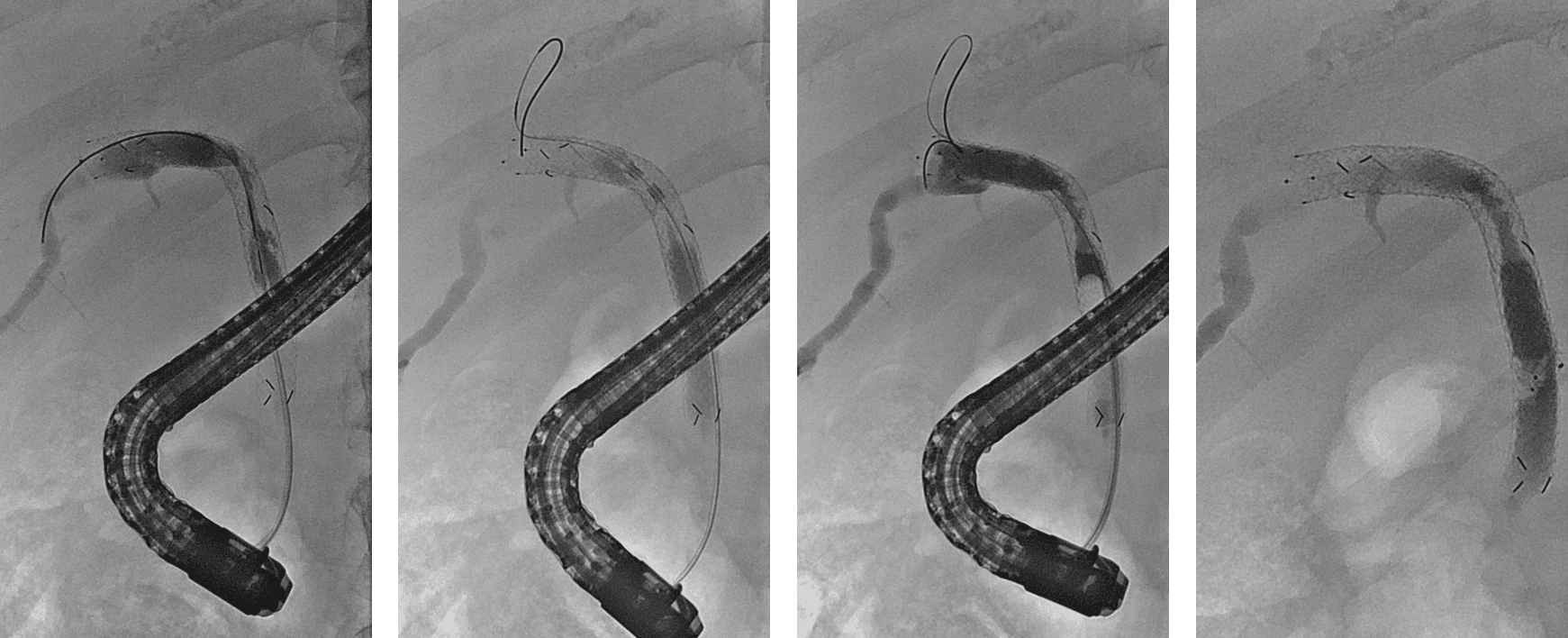Endobiliaire radiofrequente ablatie ter preventie en behandeling van ...