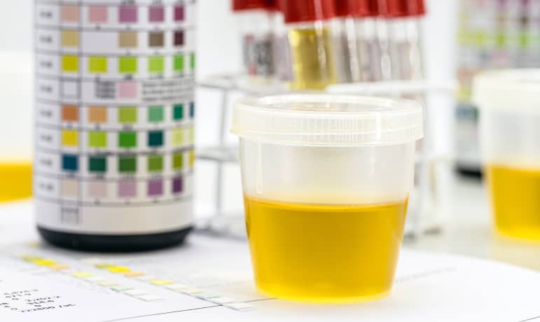 Verinurad in combinatie met allopurinol bij hyperuricemie | MedNet