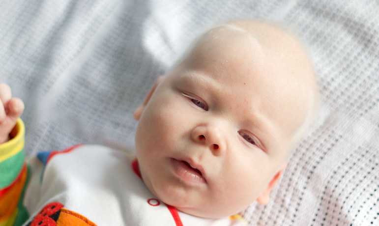 Nieuwe diagnostische criteria voor albinisme | MedNet